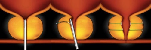 HoLEP | minimally invasive prostate surgery